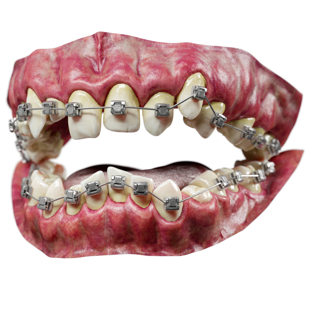 Realistic 3D Teeth with Braces Model - Includes Blender, Marmoset, and ...