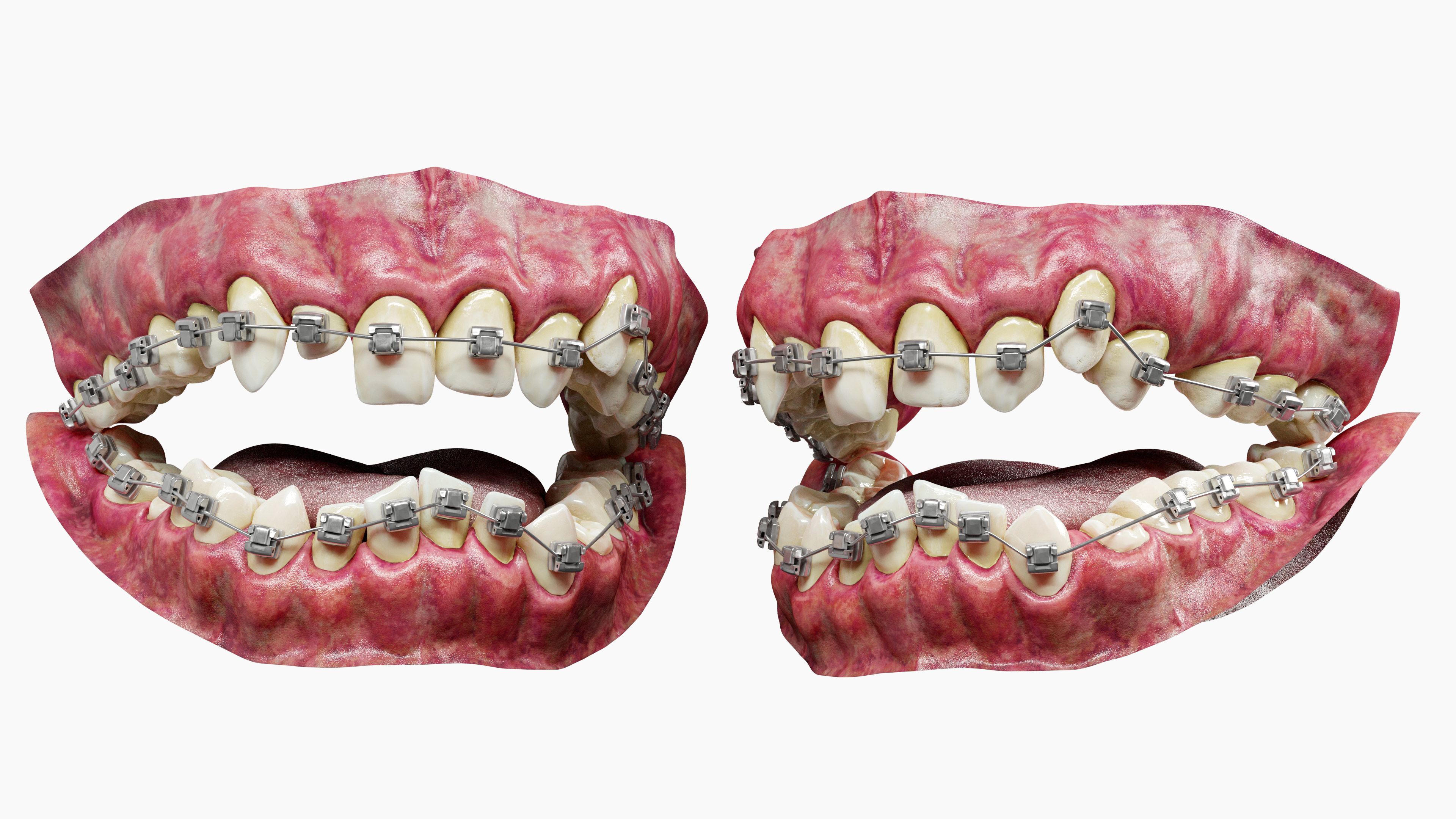 Realistic 3D Teeth with Braces Model - Includes Blender, Marmoset, and ...