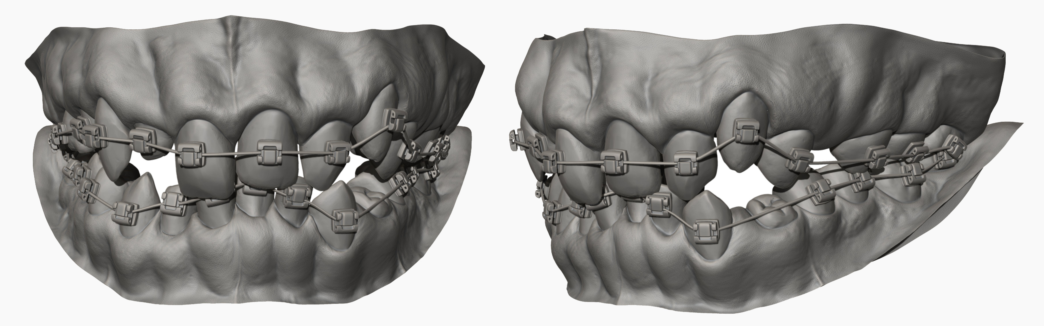 Realistic 3D Teeth with Braces Model - Includes Blender, Marmoset, and ...