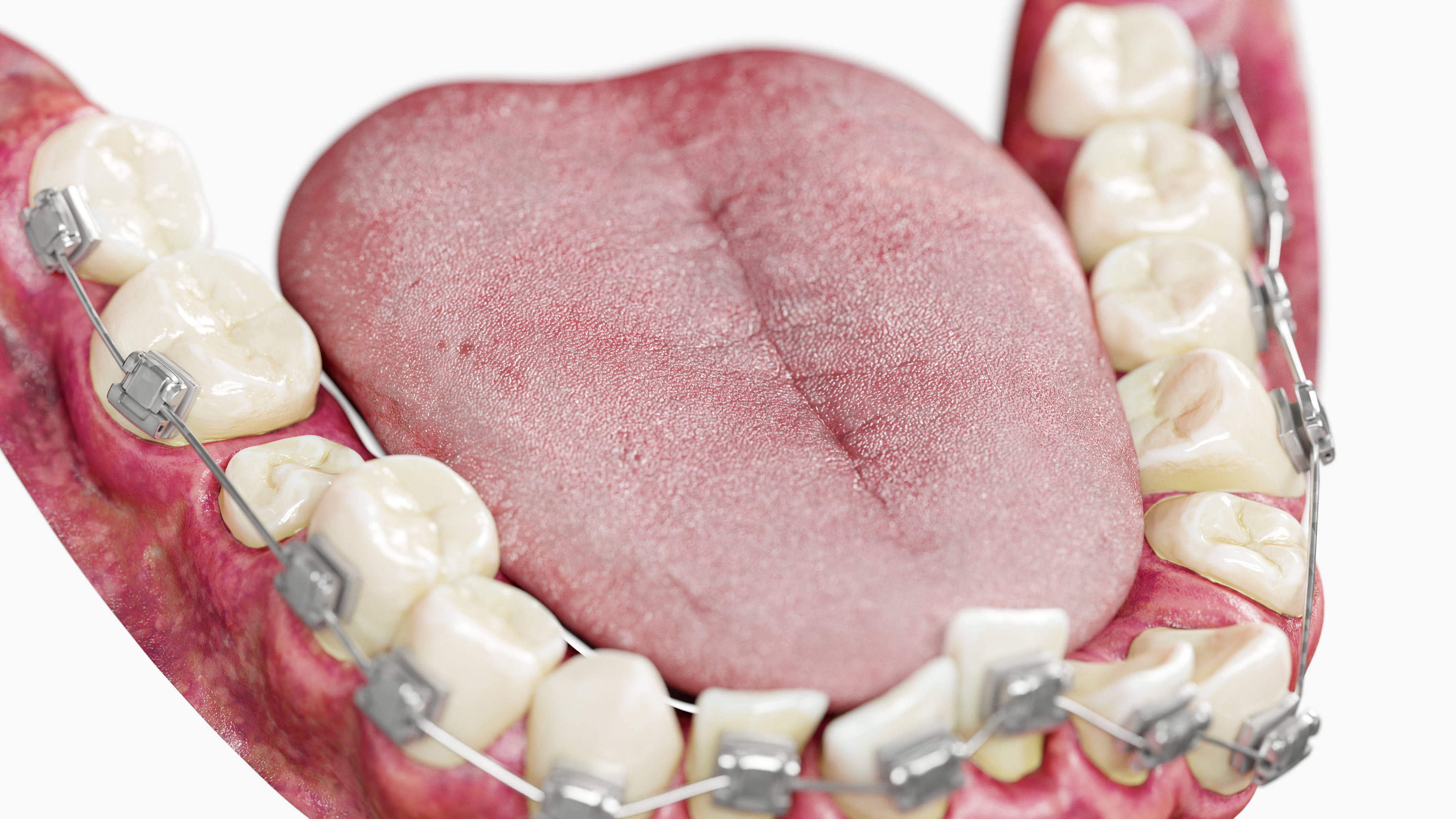 Realistic 3D Teeth with Braces Model - Includes Blender, Marmoset, and ...